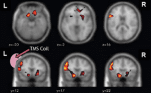 TMS Therapy - Long Island Neurocare Therapy